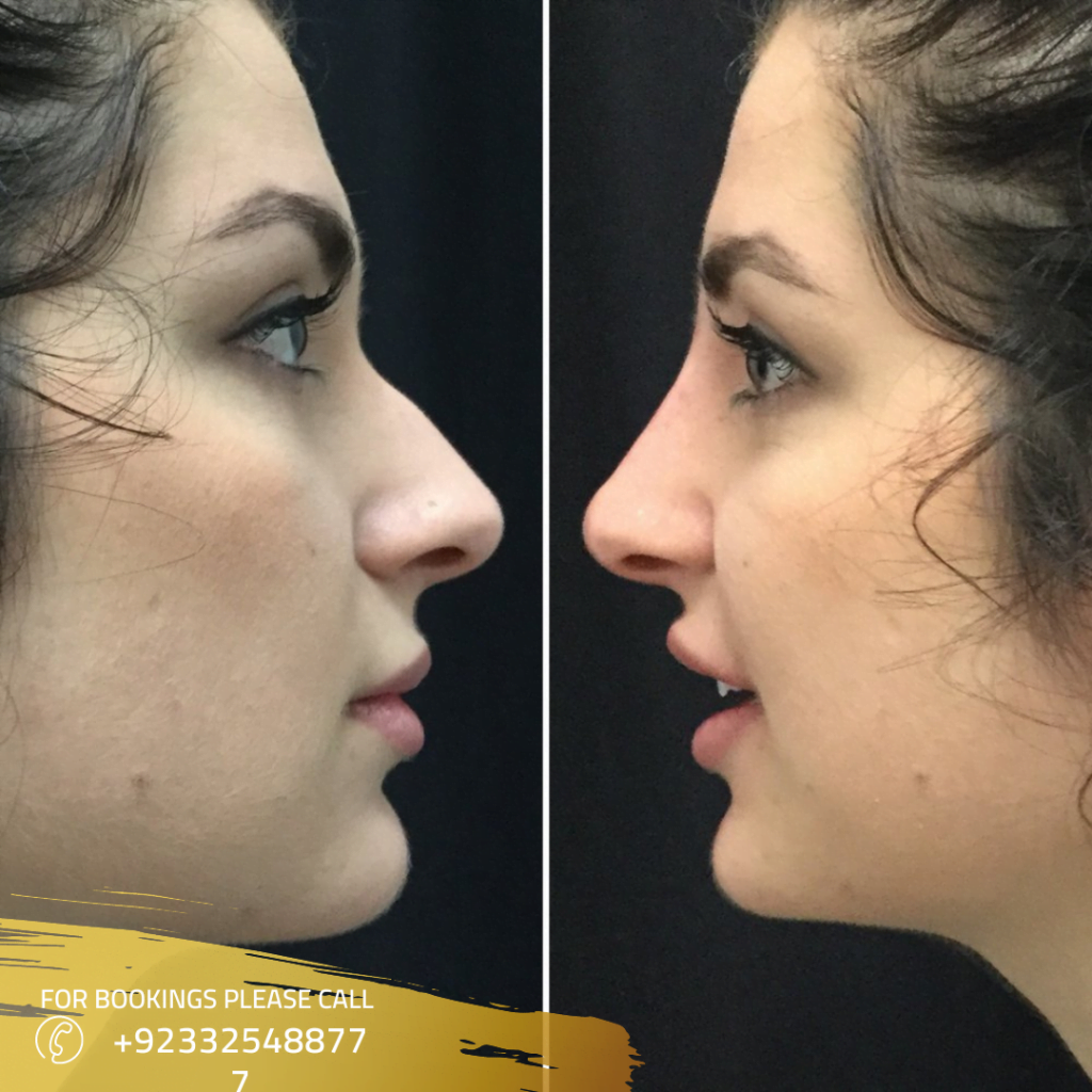 Rhinoplasty in Islamabad & Best Nose Reshaping - RCS