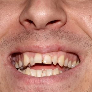 Overlapping Teeth Treatment in Islamabad - RCS