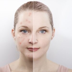 Acne scar treatment in Islamabad, Rawalpindi, and Pakistan