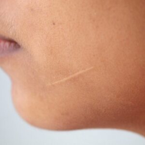 Facial Scar Revision in Islamabad, Rawalpindi, and Pakistan - RCS