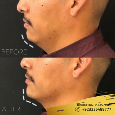 Dermal Fillers injections in Islamabad & Pakistan - RCS