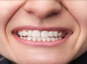 What is the best crown for implants?