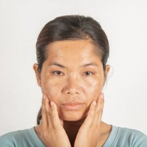 Tips to get rid of Melasma permanently
