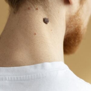 Can a birthmark grow or spread as a person ages?