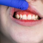 What happens when gums grow on overlapping teeth