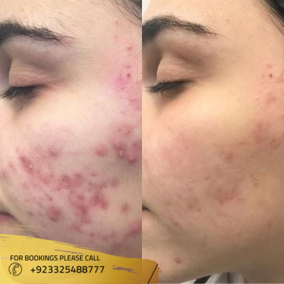 Acne scar treatment in Islamabad, Rawalpindi, and Pakistan
