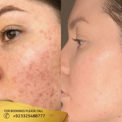 Acne scar treatment in Islamabad, Rawalpindi, and Pakistan