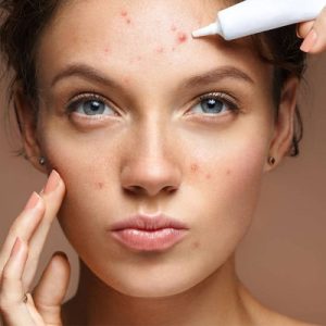 How to tell if acne is hormonal or bacterial?